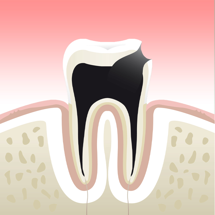 Endodontie Montpellier - Centre dentaire à Montpellier